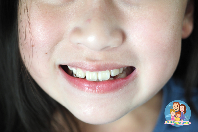 รีวิวแชร์ประสบการณ์จัดฟันเด็กเล็กด้วย EF LINE ได้ผลแค่ไหน ราคาเท่าไหร่ ...