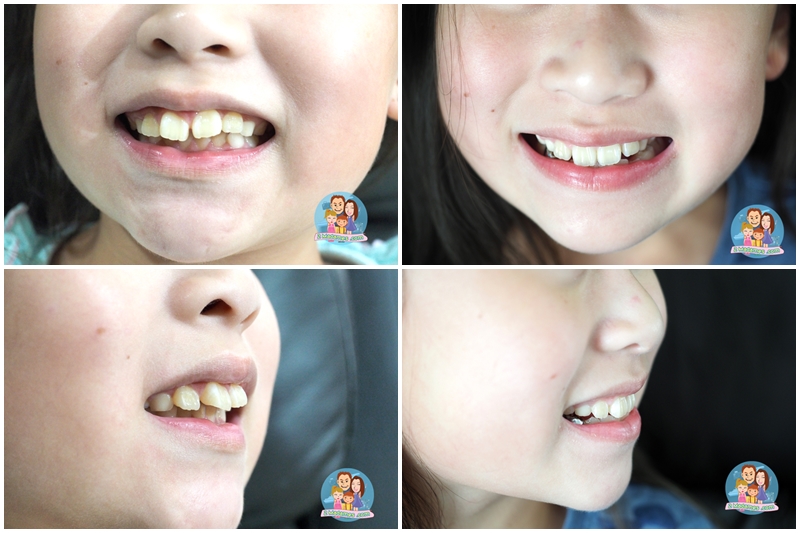 รีวิวแชร์ประสบการณ์จัดฟันเด็กเล็กด้วย EF LINE ได้ผลแค่ไหน ราคาเท่าไหร่ ...
