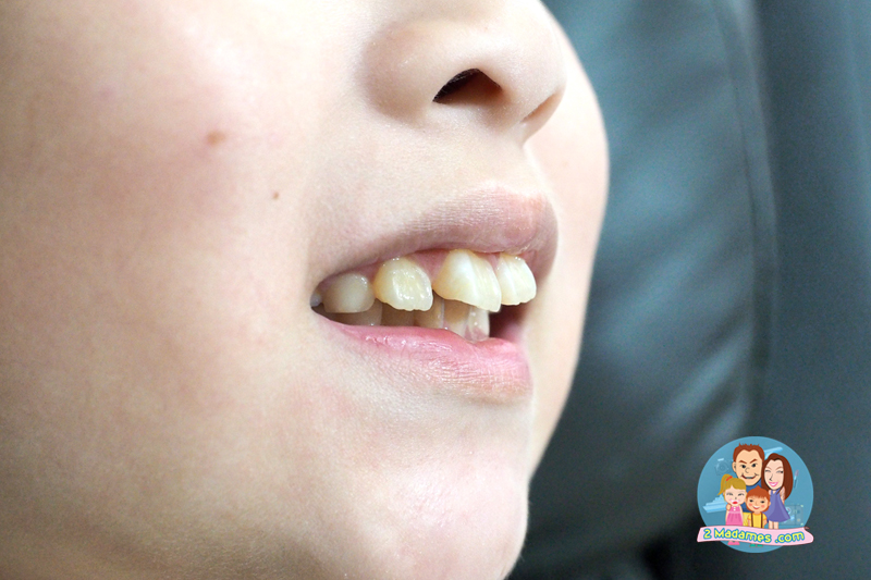 รีวิวแชร์ประสบการณ์จัดฟันเด็กเล็กด้วย EF LINE ได้ผลแค่ไหน ราคาเท่าไหร่ ...