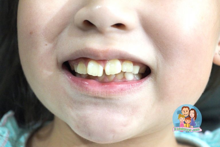 รีวิวแชร์ประสบการณ์จัดฟันเด็กเล็กด้วย EF LINE ได้ผลแค่ไหน ราคาเท่าไหร่ มาดูกัน | 2Madames.com ...